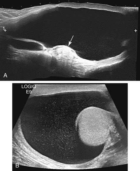 Epididymal Cyst Ultrasound