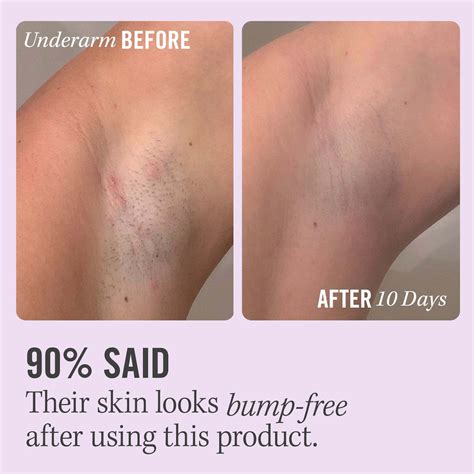 Ingrown Hair Cyst Armpit