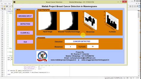 Matlab Project Breast Cancer Detection In Mammograms Using Image Processing Full Source Code