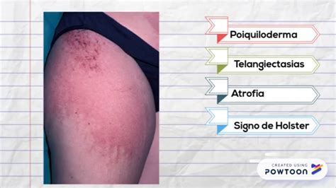 Dermatomiositis Youtube