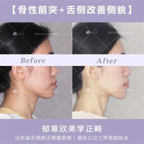 青岛牙齿矫正 青岛正畸 骨性前突 上颌人中长 舌侧矫正调整侧貌 知乎