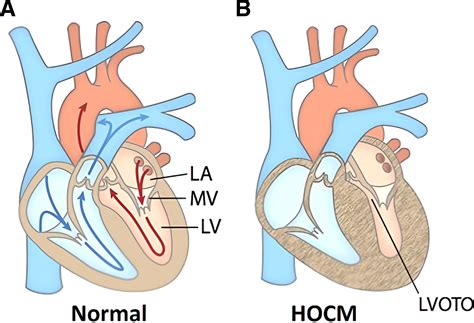 Asymmetry Of Flow In Aortic Root And Its Application In Hypertrophic