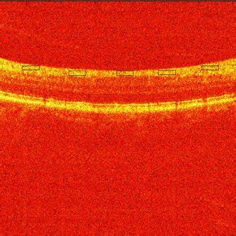 Sample Of An OCT Image Of A Normal Retina Download Scientific Diagram