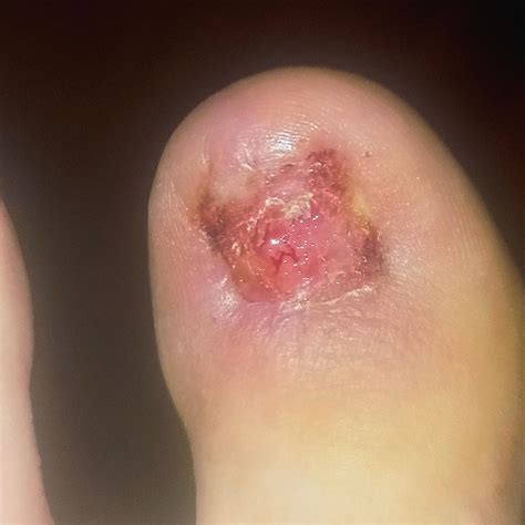 Week After Total Avulsion Surgery Ringrowntoenails