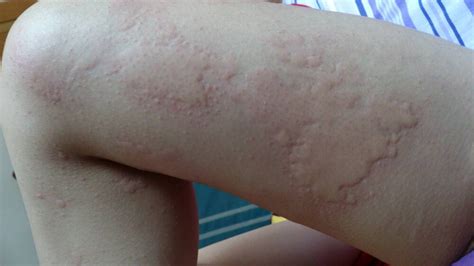 一到晚上就出风团疹风团疹大山谷图库