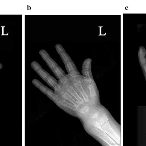Radiographs Of The Patient 1 With Vddr Ia A Before Treatment Wrist Download Scientific