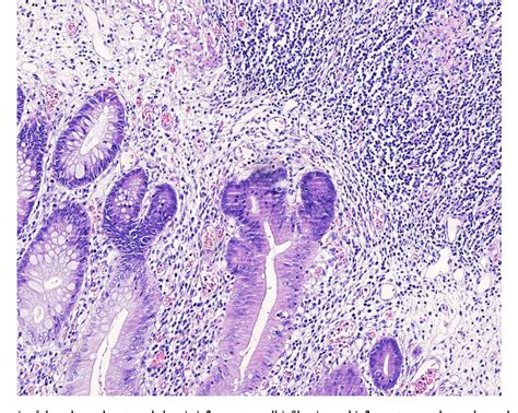 Sigmoid Colon Perforation With Splenic Abscess Due To Ulcerative Colitis A Case Report And