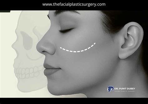 Zygoma Reduction Uk