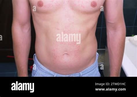 K A Man With A Naked Torso Scratches A Red Rash On His Stomach Slow