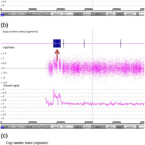 Snp Microarray Results Showing Predicted Duplications Indicated By Red