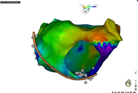 A Patient With A Prior Surgical Ablation To Isolate The Pulmonary Veins Download Scientific