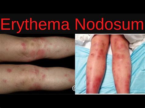 Erythema Nodosum Sarcoidosis Erythema Nodosum F M Causes