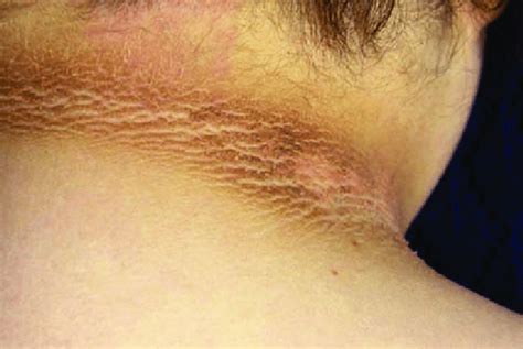 Acanthosis Nigricans Download Scientific Diagram