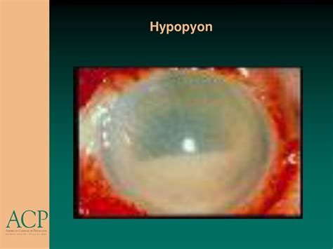 Ppt Quick Guide To Corneal Conditions Symptoms Treatment And
