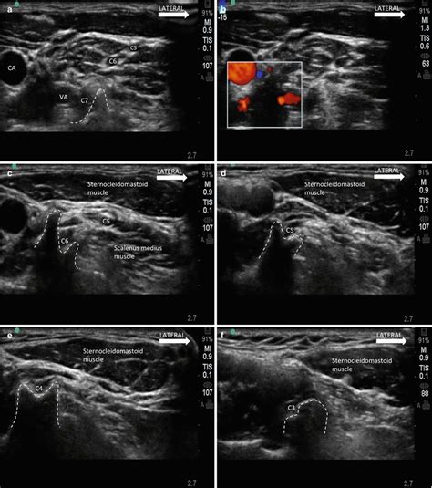 Deep And Superficial Cervical Plexus Anesthesia Key