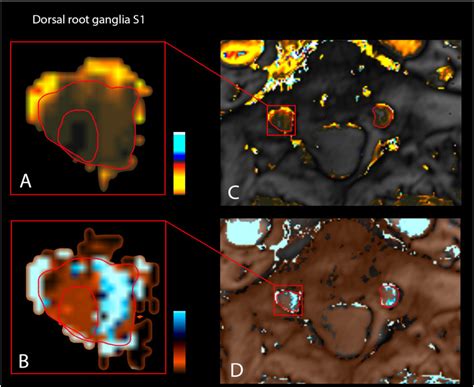 Perfusion Parameter Maps In S1 Drg Parameter Maps For K Trans And V E Download Scientific