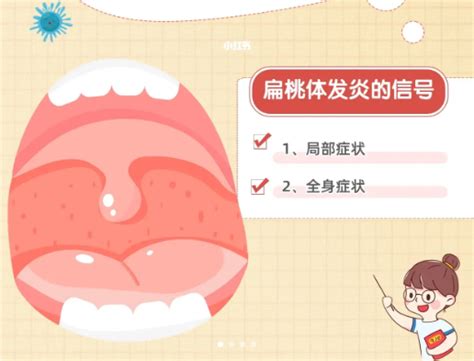 扁桃体总发炎？进来看看这些症状你中了几条 知乎