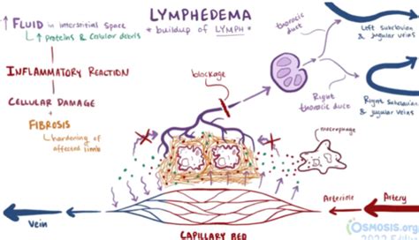 Lymphatic Disorders Flashcards Quizlet