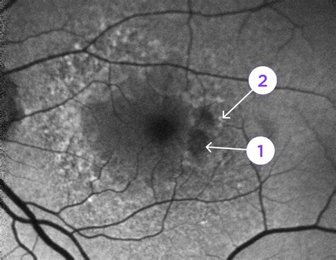 Protect Your Patients Vision And Treat Geographic Atrophy Ga Today