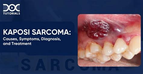 Kaposi Sarcoma Causes Symptoms Diagnosis And Treatment