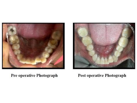 How Does A Crown Work After A Root Canal Verlie Duckworth