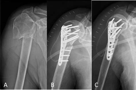 A Displaced Two Part Proximal Humeral Fracture In A 69 Year Old Male Download Scientific