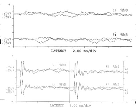 Week 5 Ansd And Cochlear Synaptopathy And Ndx Abr Flashcards Quizlet
