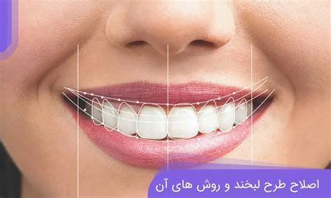 نحوه اصلاح طرح لبخند با بررسی هزینه، مزایا و معایب هر روش