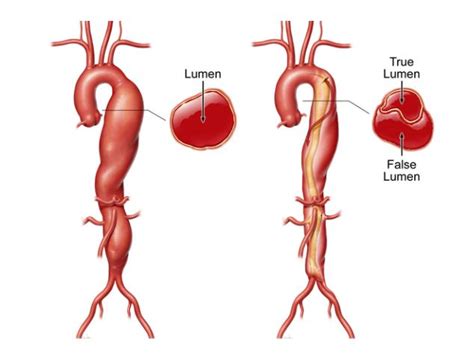 Aorta Disease Treatment And Prevention Seton Dr Sanjay Kumar Agarwal