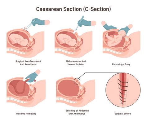 Cesarean Section Procedure