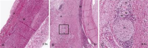 Pathogenesis Of Inflammatory Aortic Aneurysms Clinical Tree