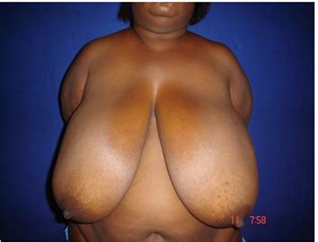 Gigantomastia In Female Workers Public Health Cases”
