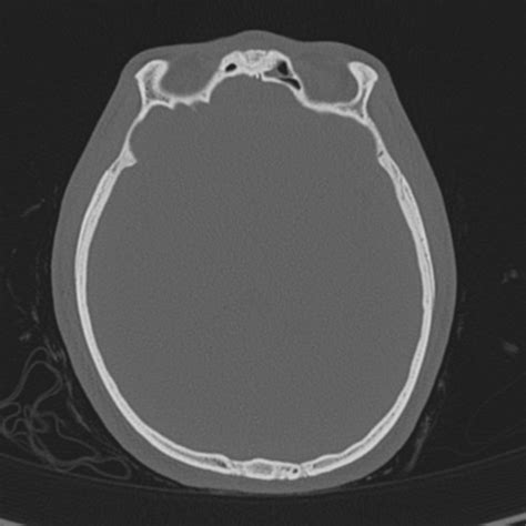 Ct Anatomy Of Brain Bone Window At Samuel Woolley Blog