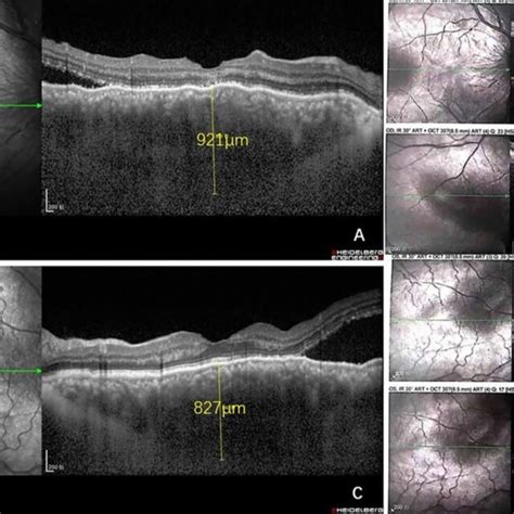 Optical Coherence Tomography Oct Showed Neuroepithelial Detachment Download Scientific