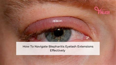 How To Treat Blepharitis Eyelash Extensions Effectively