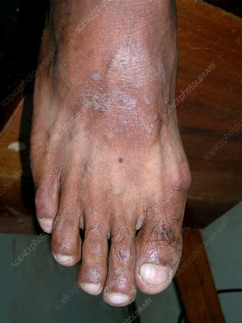 Contact Dermatitis Stock Image C0570622 Science Photo Library