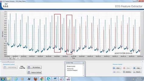 The P Waves Mimic The QRS Peak Download Scientific Diagram