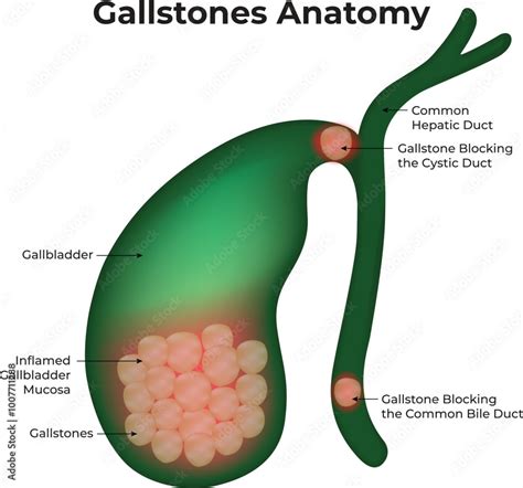 Gallstones Anatomy Gallbladder Hepatic Duct Mucosa Science Vector