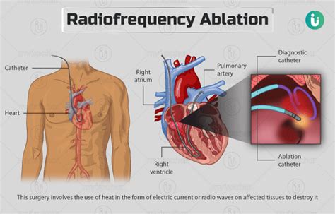 Cardioversion After Ablation Catheter Ablation In End Stage Heart