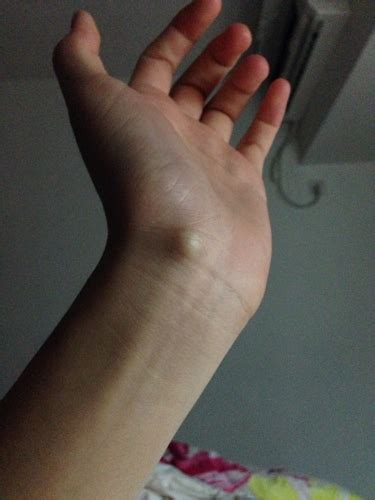 手腕关节处凸起个小包 手腕关节处凸起 伤感说说吧