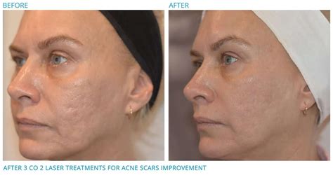 Fractionated Co2 Laser Co2 Laser Skin Resurfacing With Sculptra Facial