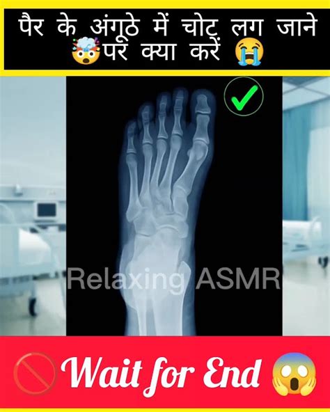 पैर में चोट लग जाने पर क्या करें पैर का अंगूठा चोट लगने पर काला हो तो क्या करें😱😭😭 Shortfeed