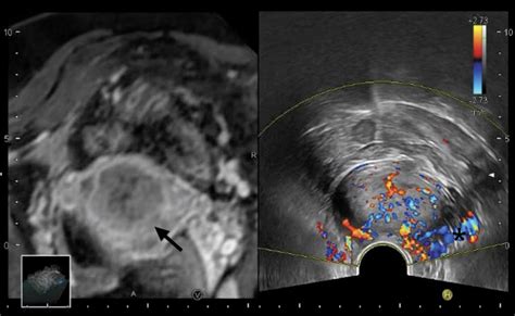 Mri And Ultrasound Fusion Imaging For Cervical Cancer Anticancer Research