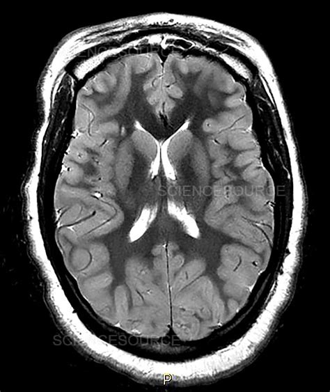 Photograph Diffuse Anoxic Injury After Cardiac Ar Science Source Images
