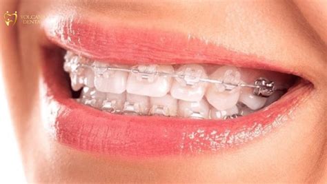 Răng Hô Là Gì Nguyên Nhân Phương Pháp điều Trị Răng Bị Hô Hiệu Quả