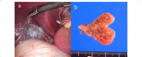 Operative Findings And Resected Specimen A Operative Findings The Download Scientific Diagram