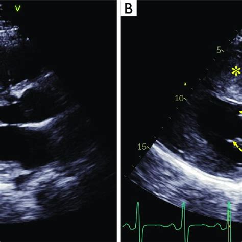 Papillary Muscle Abnormalities In Hypertrophic Cardiomyopathy A An