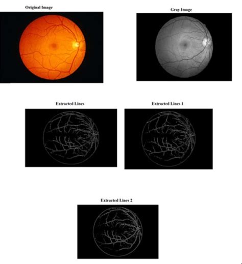 Sharing My Nn Retina Detection Project By Sivaram S Medium