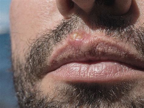 Small Blisters On Lips Cold Sore