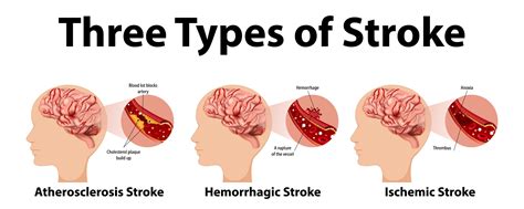 Types Of Strokes Vitality Living